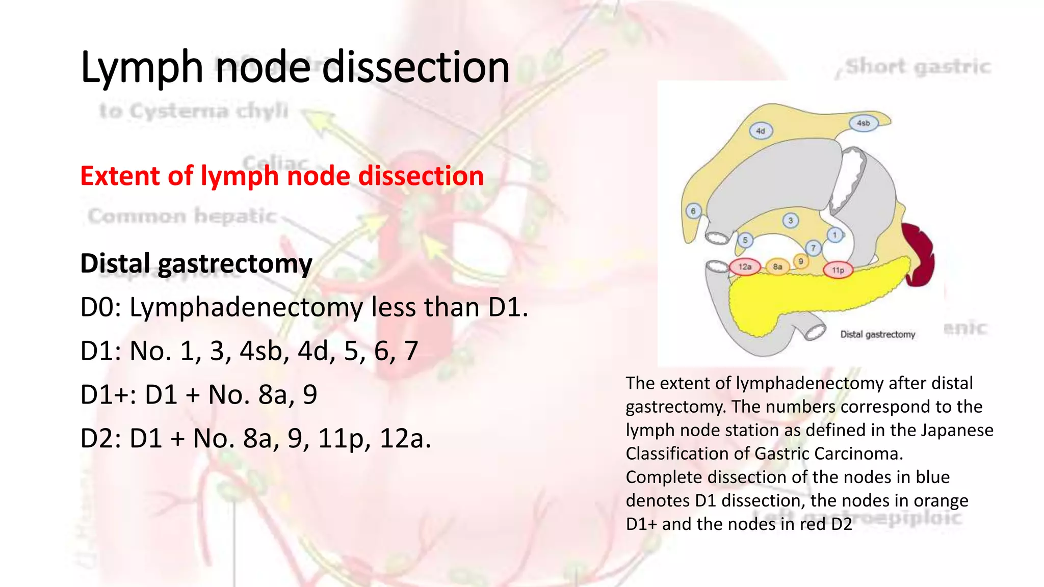 Management of metastatic lymph nodes in gastric cancer | PPTX