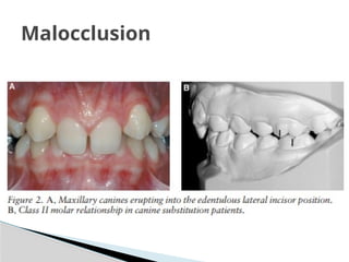 Management of Missing Lateral Incisors.pptx