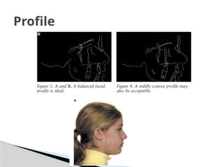 Management of Missing Lateral Incisors.pptx