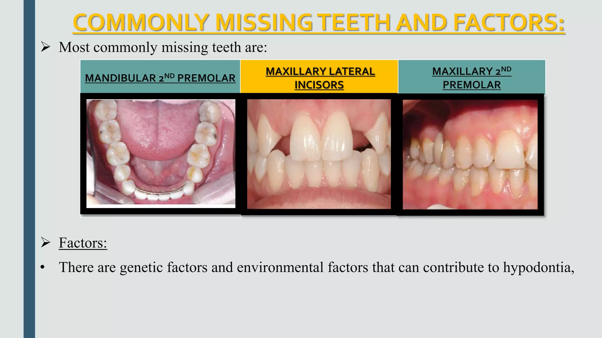 Management of missing maxillary lateral incisor | PPTX