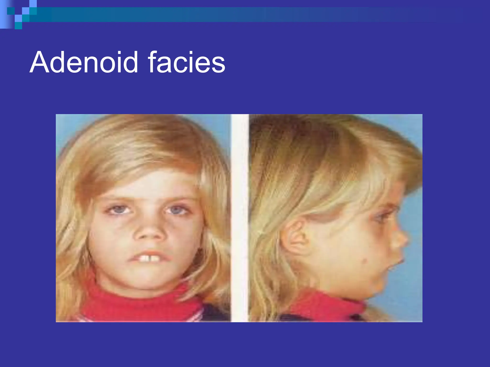 Management of Nasal Obstruction.ppt