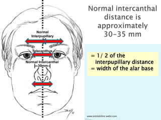 Management of nasoethmoidal fractures | PPT