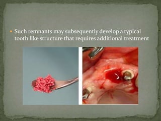 Management of natal and neonatal teeth | PPTX