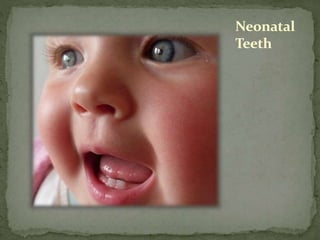 Management of natal and neonatal teeth | PPTX