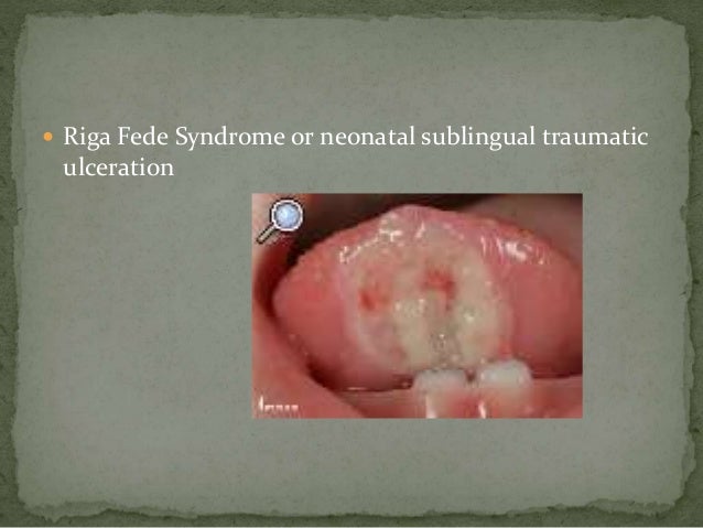 Management of natal and neonatal teeth