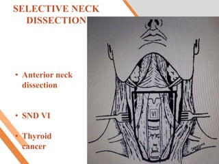 Management of neck in oral squamous cell carcinoma | PPTX