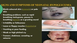 Management of neonatal hypoglycemia | PPTX
