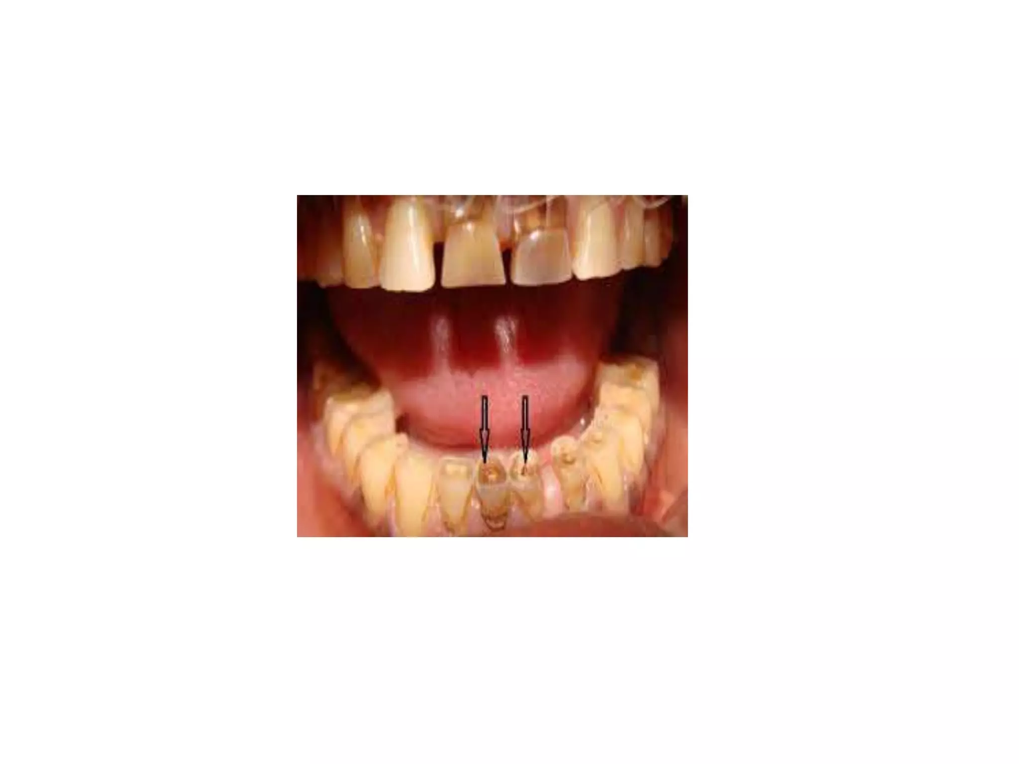 Management of non carious lesions- attrion, abrasion, erosion ...