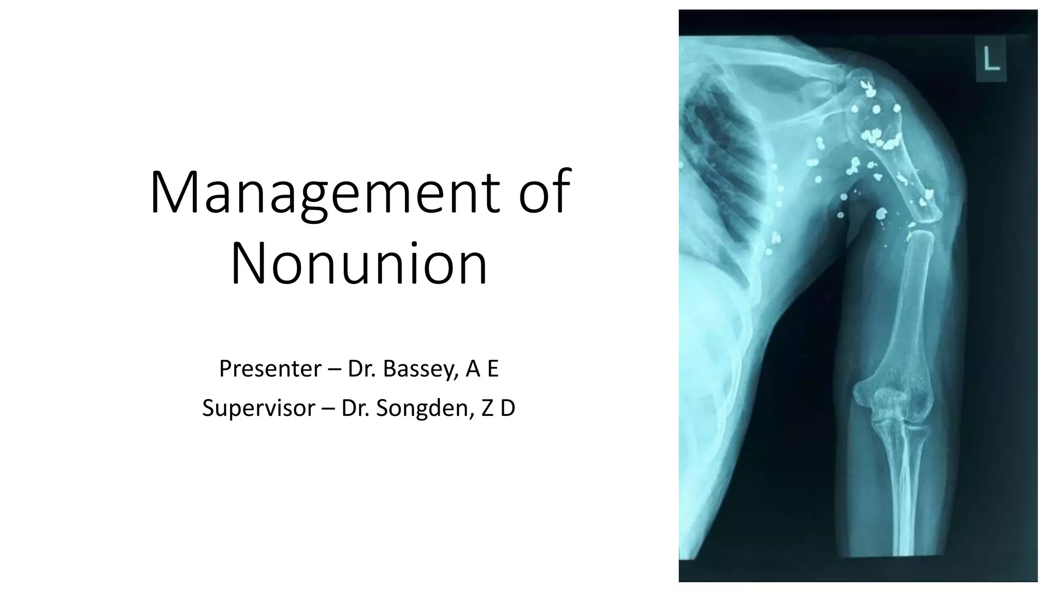 Management of Nonunion | PPTX
