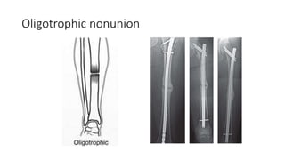 Management of Nonunion | PPTX
