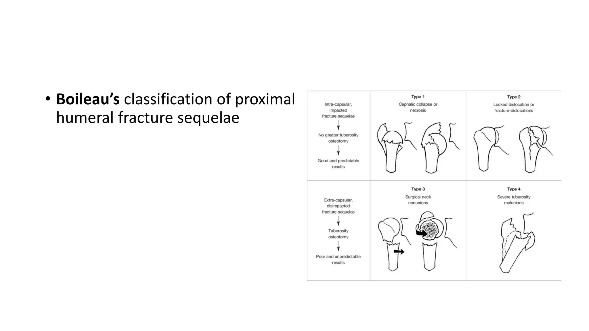 MANAGEMENT OF NONUNIONS AND MALUNIONS OF PROXIMAL HUMERAL FRACTURES.pptx