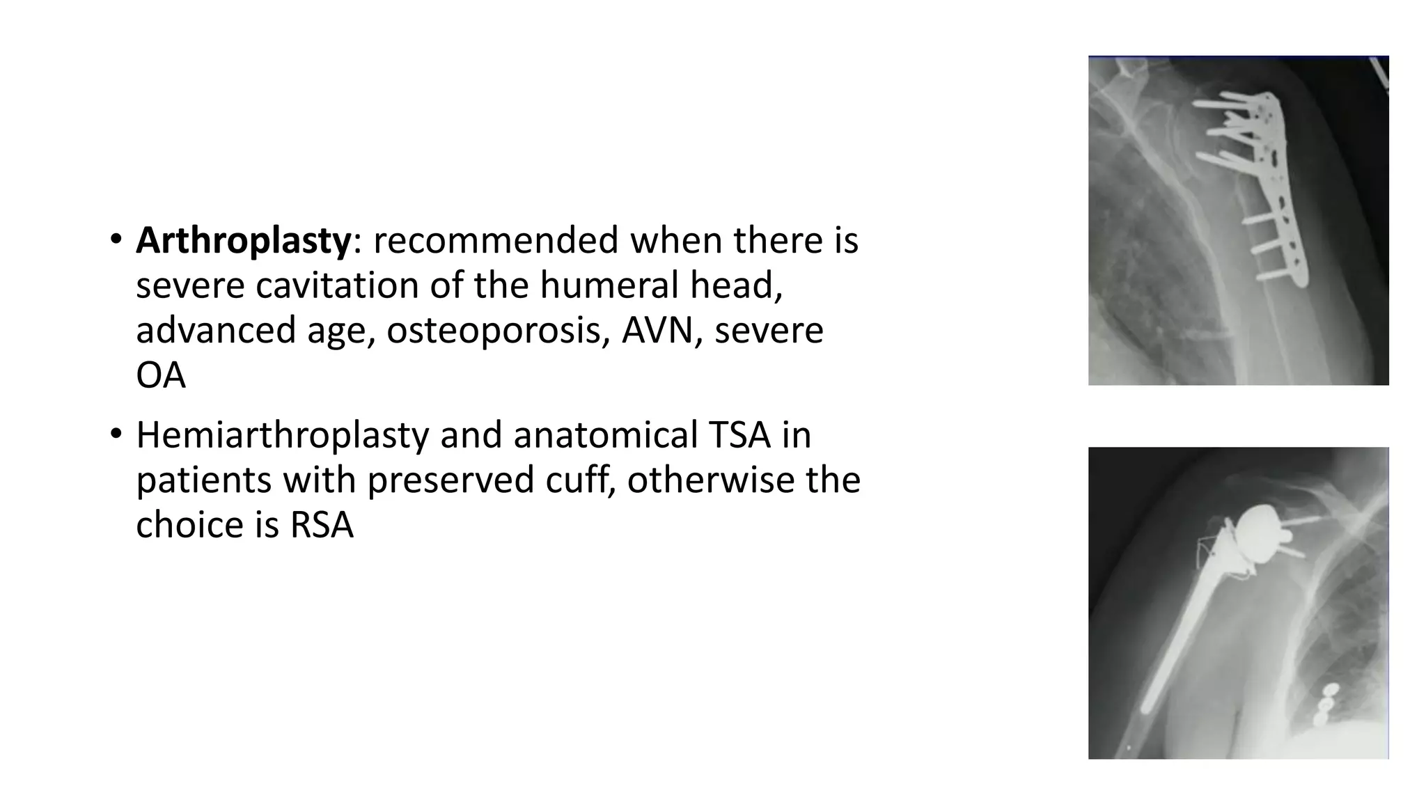 MANAGEMENT OF NONUNIONS AND MALUNIONS OF PROXIMAL HUMERAL FRACTURES.pptx