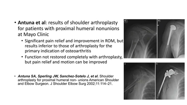 MANAGEMENT OF NONUNIONS AND MALUNIONS OF PROXIMAL HUMERAL FRACTURES.pptx