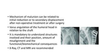 MANAGEMENT OF NONUNIONS AND MALUNIONS OF PROXIMAL HUMERAL FRACTURES.pptx