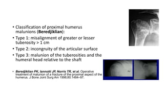 MANAGEMENT OF NONUNIONS AND MALUNIONS OF PROXIMAL HUMERAL FRACTURES.pptx
