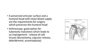 MANAGEMENT OF NONUNIONS AND MALUNIONS OF PROXIMAL HUMERAL FRACTURES.pptx