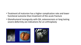 MANAGEMENT OF NONUNIONS AND MALUNIONS OF PROXIMAL HUMERAL FRACTURES.pptx