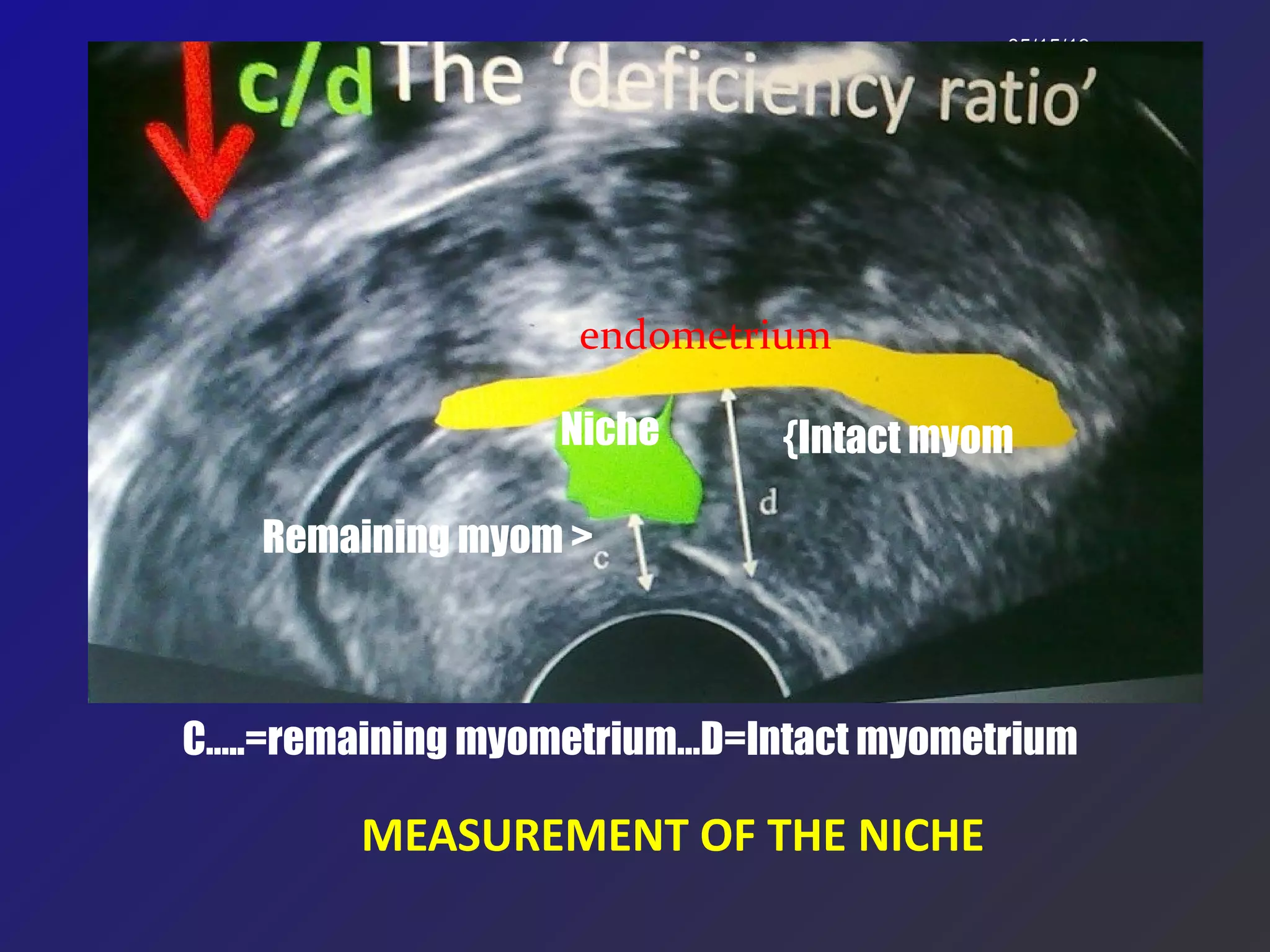 Management of not yet classified AUB..CESAREAN SCAR DEFECT,UTERINE ...