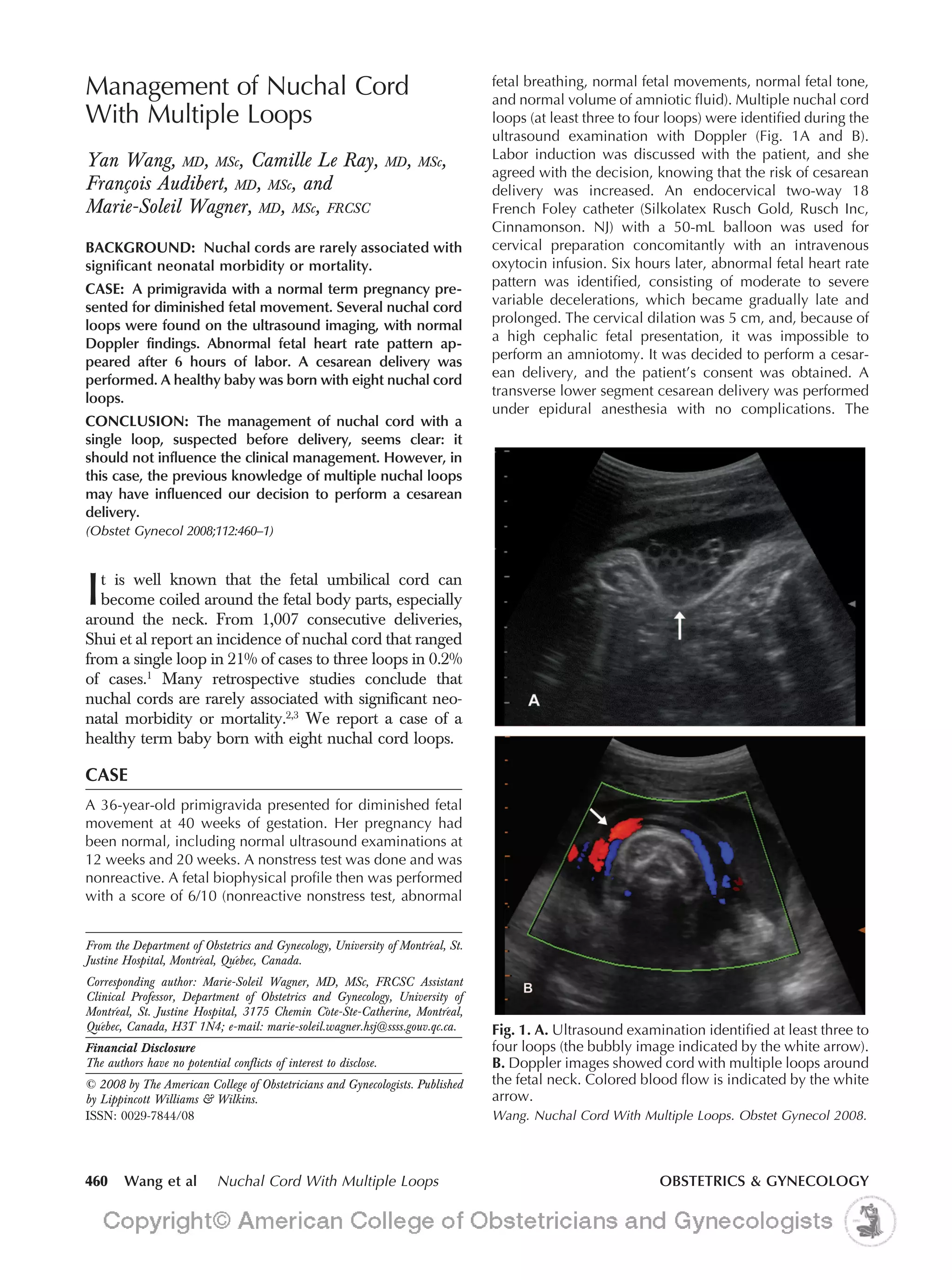 Management of nuchal cord with multiple loops. | PDF Management of nuchal cord with multiple loops. | PDF