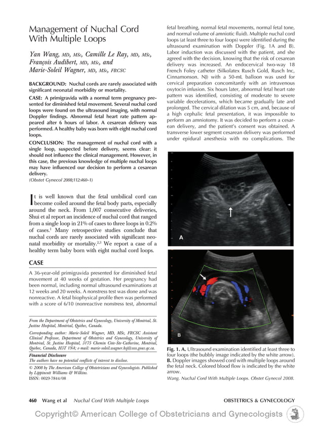 Management of nuchal cord with multiple loops. | PDF