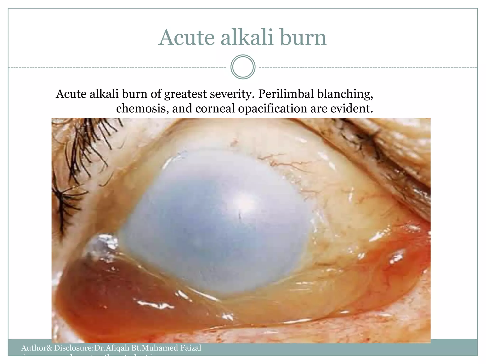 Management of ocular chemical injuries | PPTX