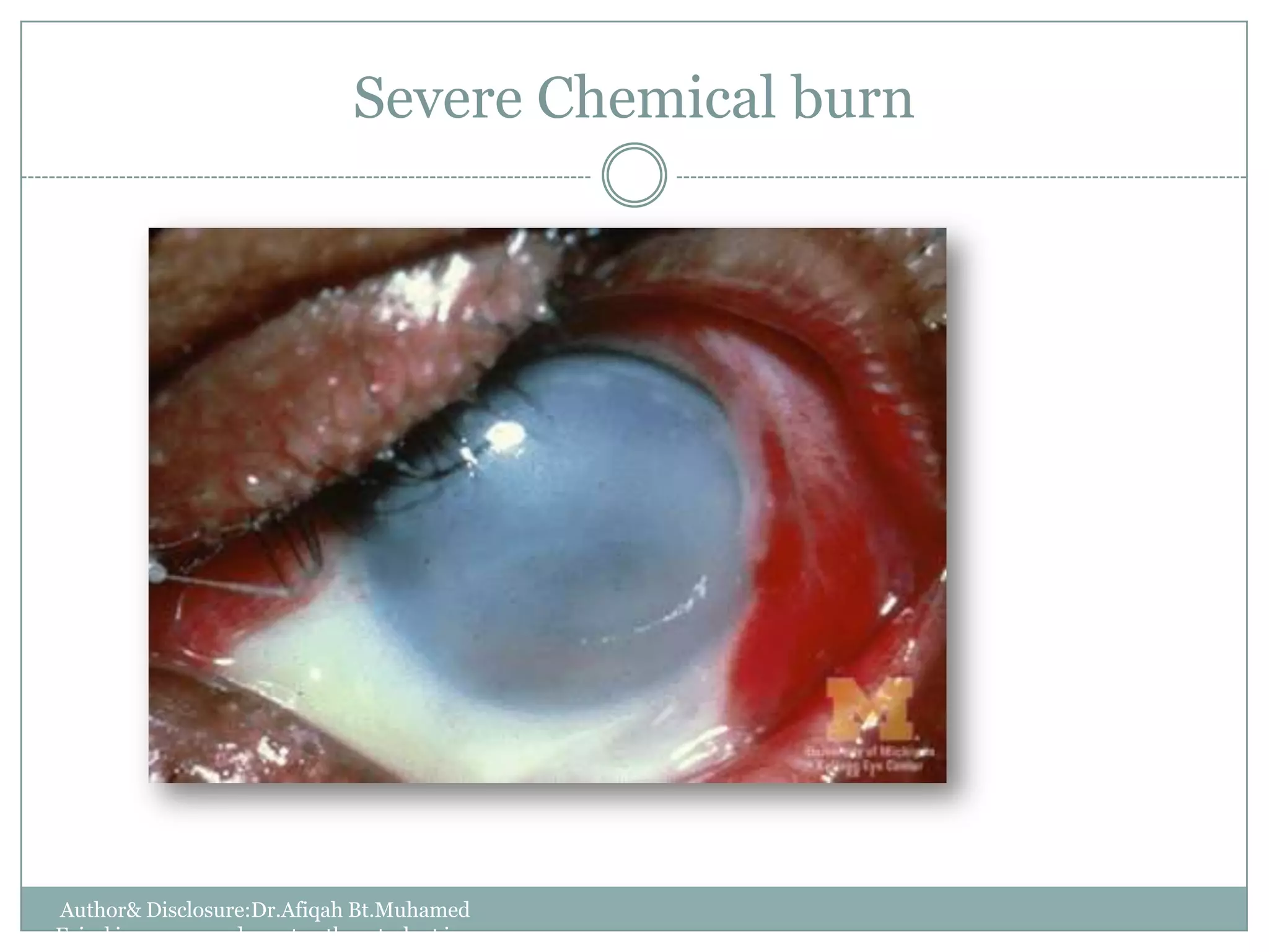 Management of ocular chemical injuries | PPTX