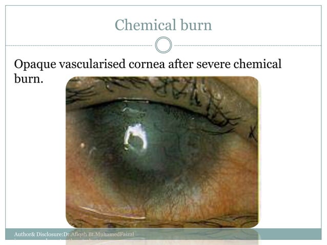 Management of ocular chemical injuries | PPTX