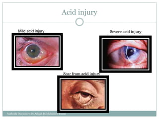 Management of ocular chemical injuries | PPTX