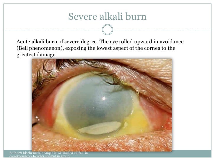 Management of ocular chemical injuries