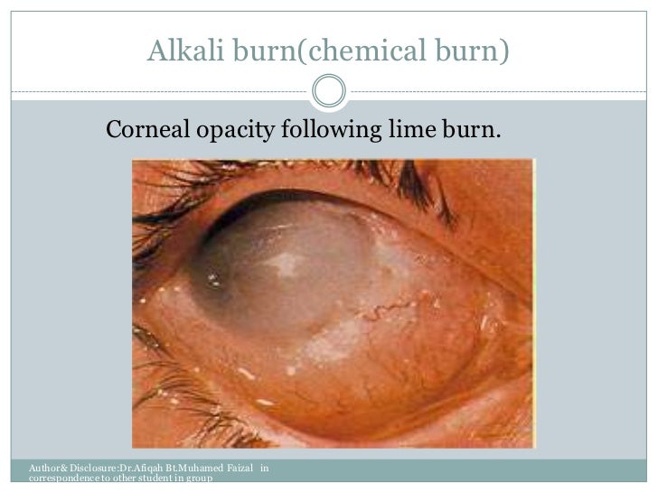 Management of ocular chemical injuries