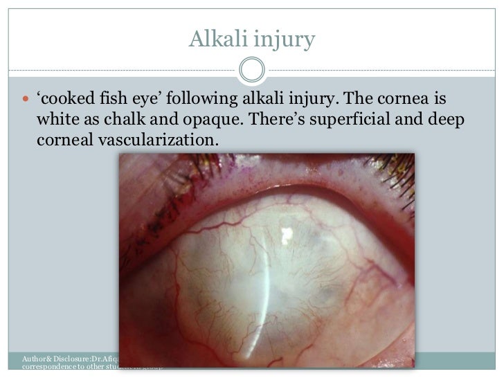 Management of ocular chemical injuries