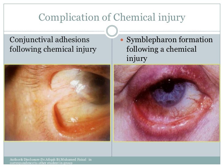 Management of ocular chemical injuries