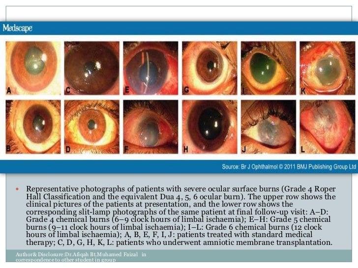 Management of ocular chemical injuries