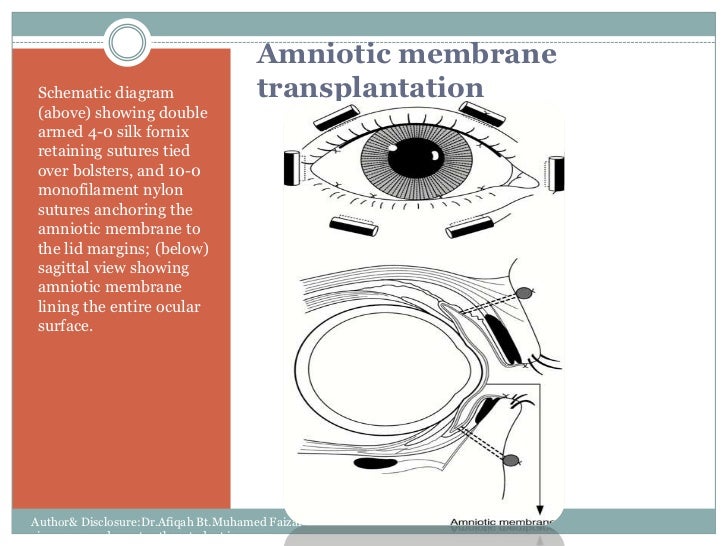 Management of ocular chemical injuries