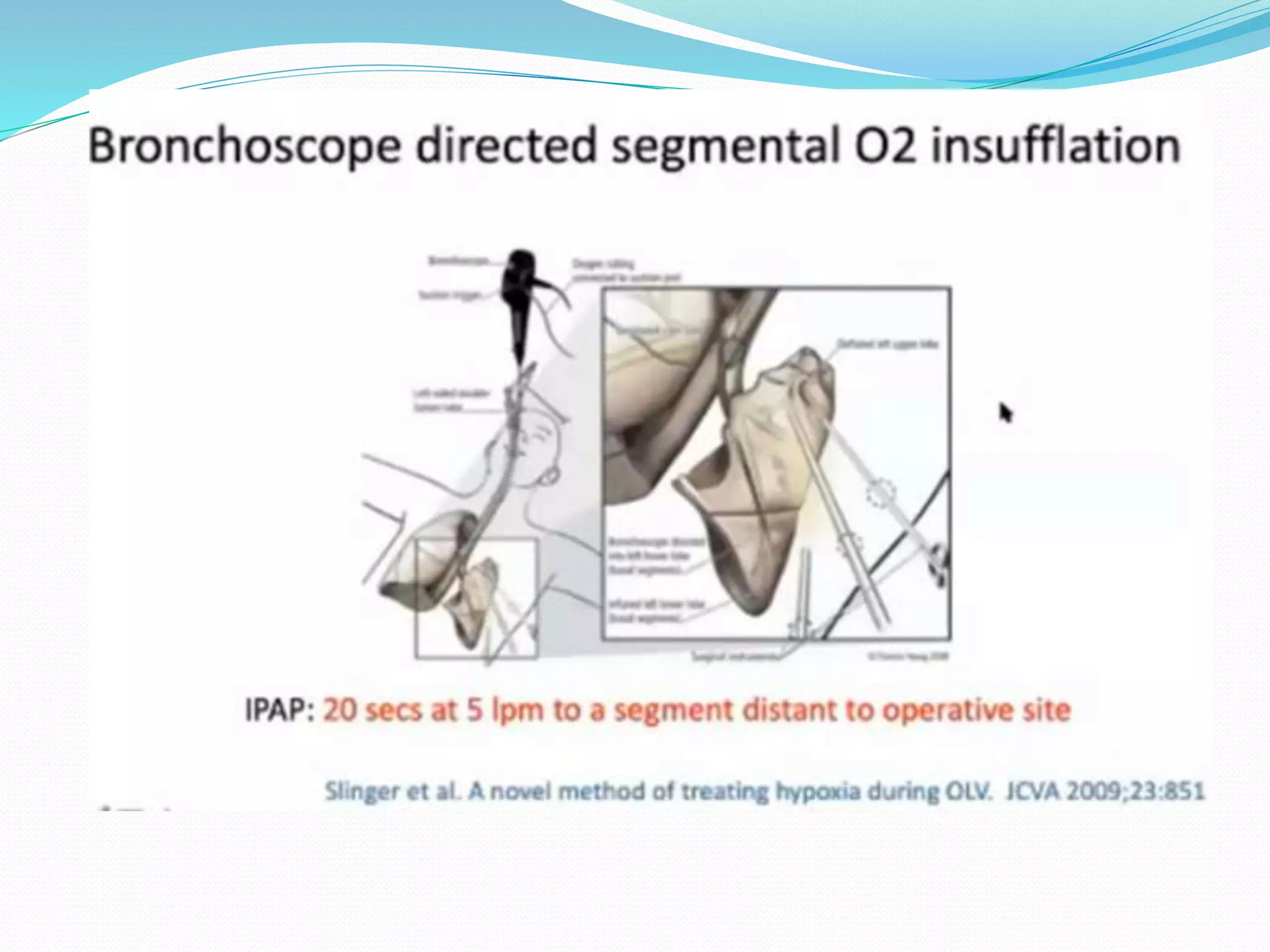 MANAGEMENT OF ONE LUNG VENTILATION.pptx