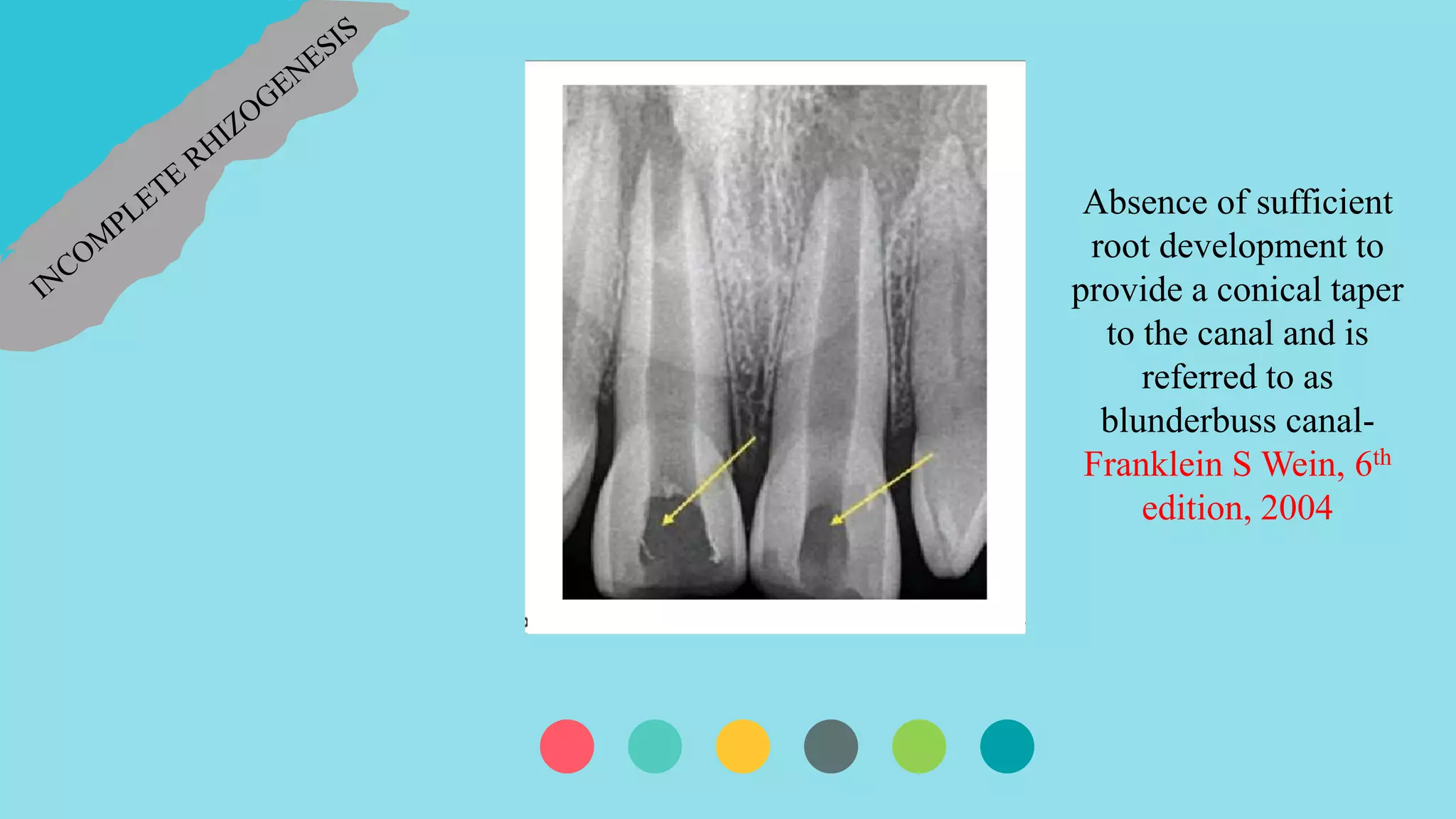 Management of open apex | PPT