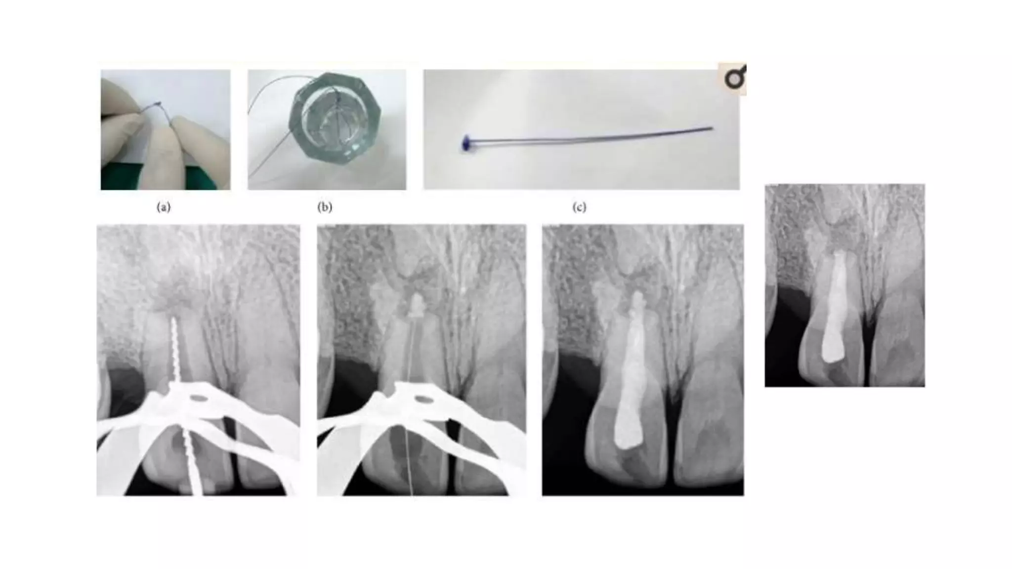 Management of open apex | PPT