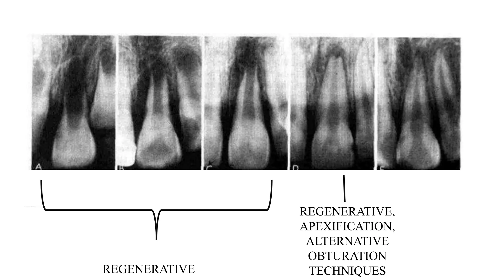 Management of open apex | PPT
