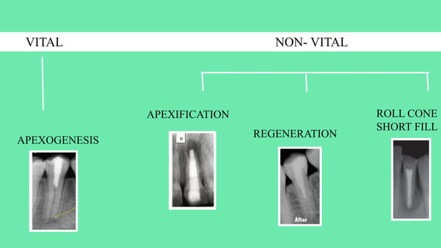 Management of open apex | PPT