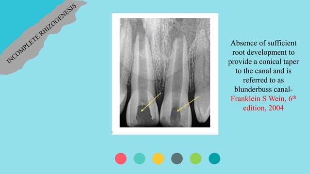 Management of open apex