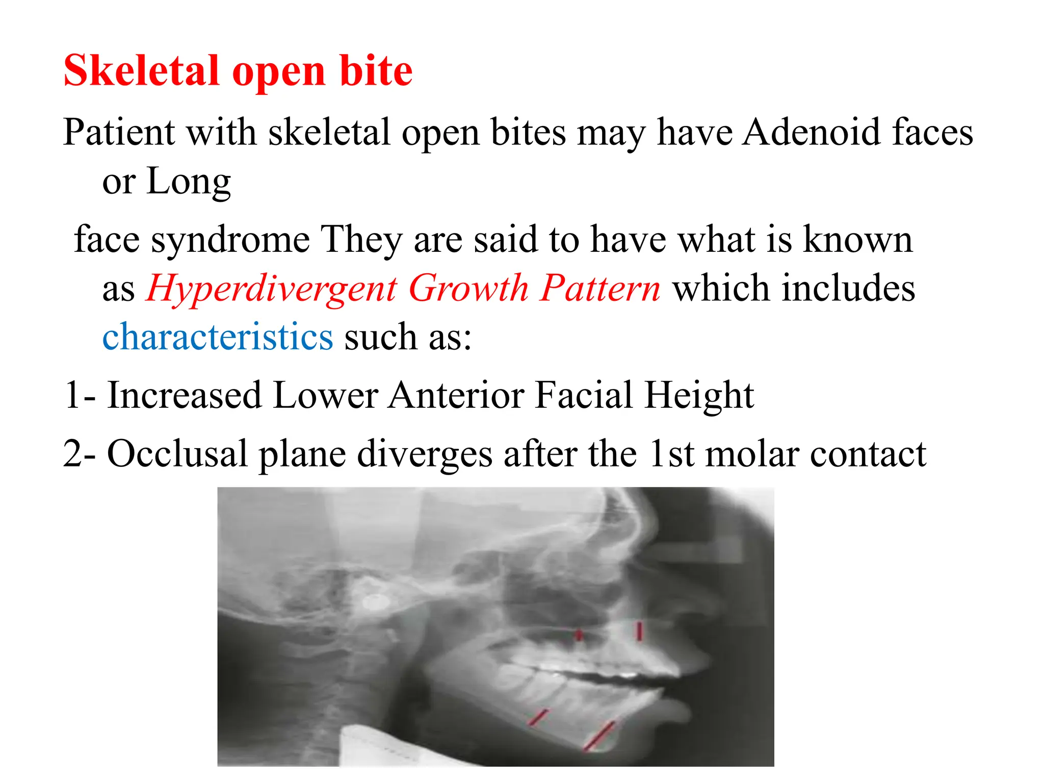 Management of open bite in orthodontics... | PPTX