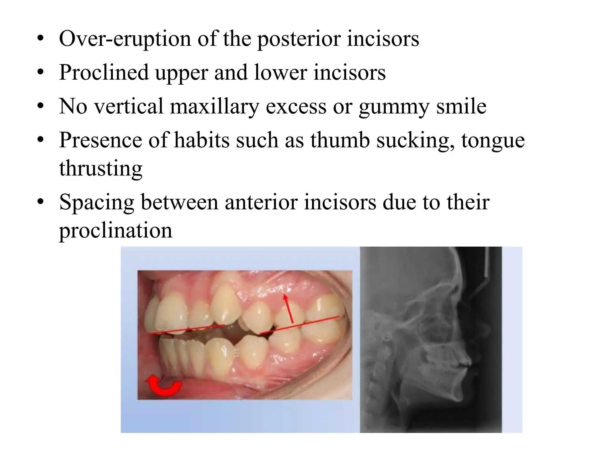 Management of open bite in orthodontics... | PPTX