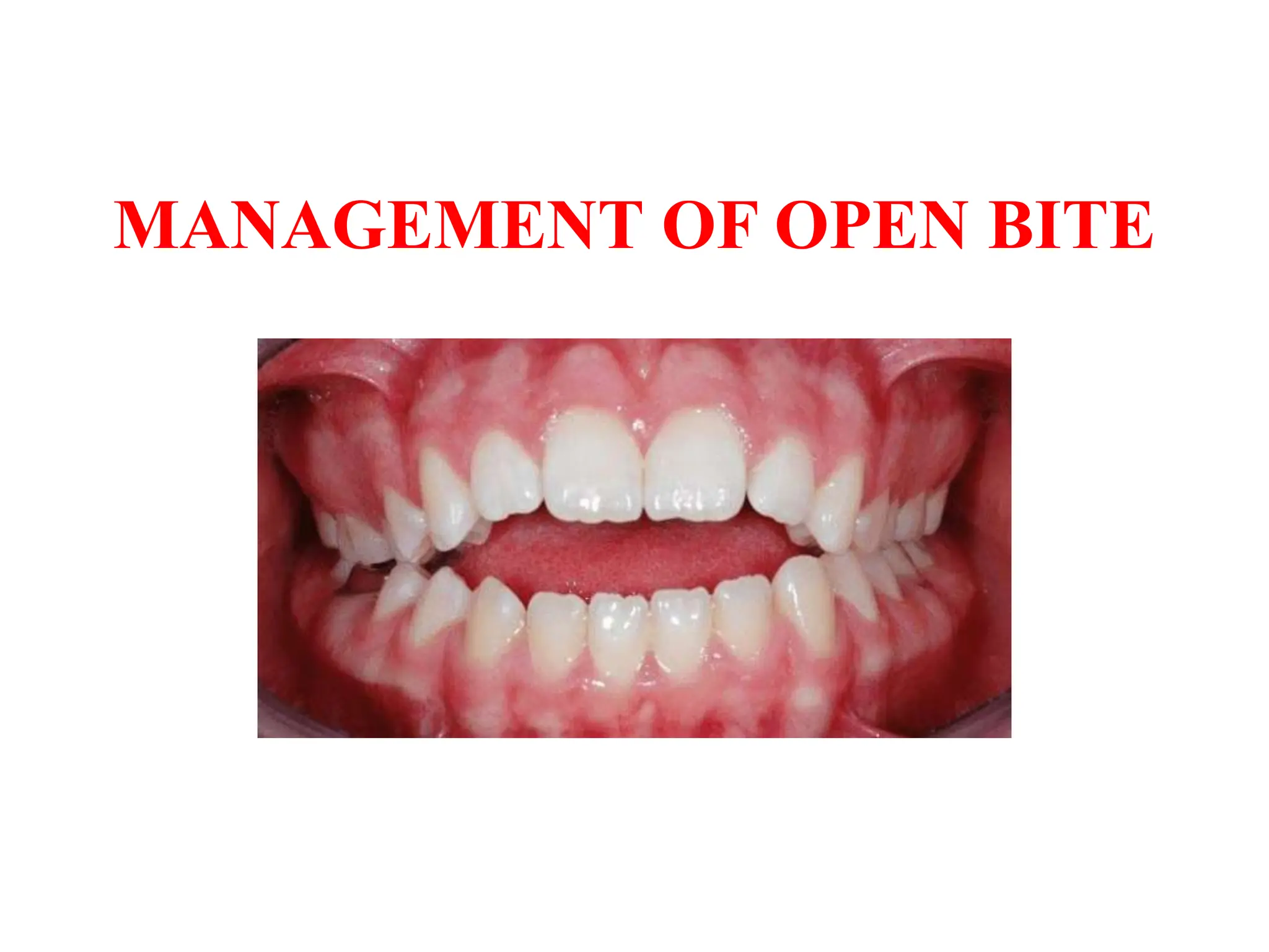 Management of open bite in orthodontics... | PPTX