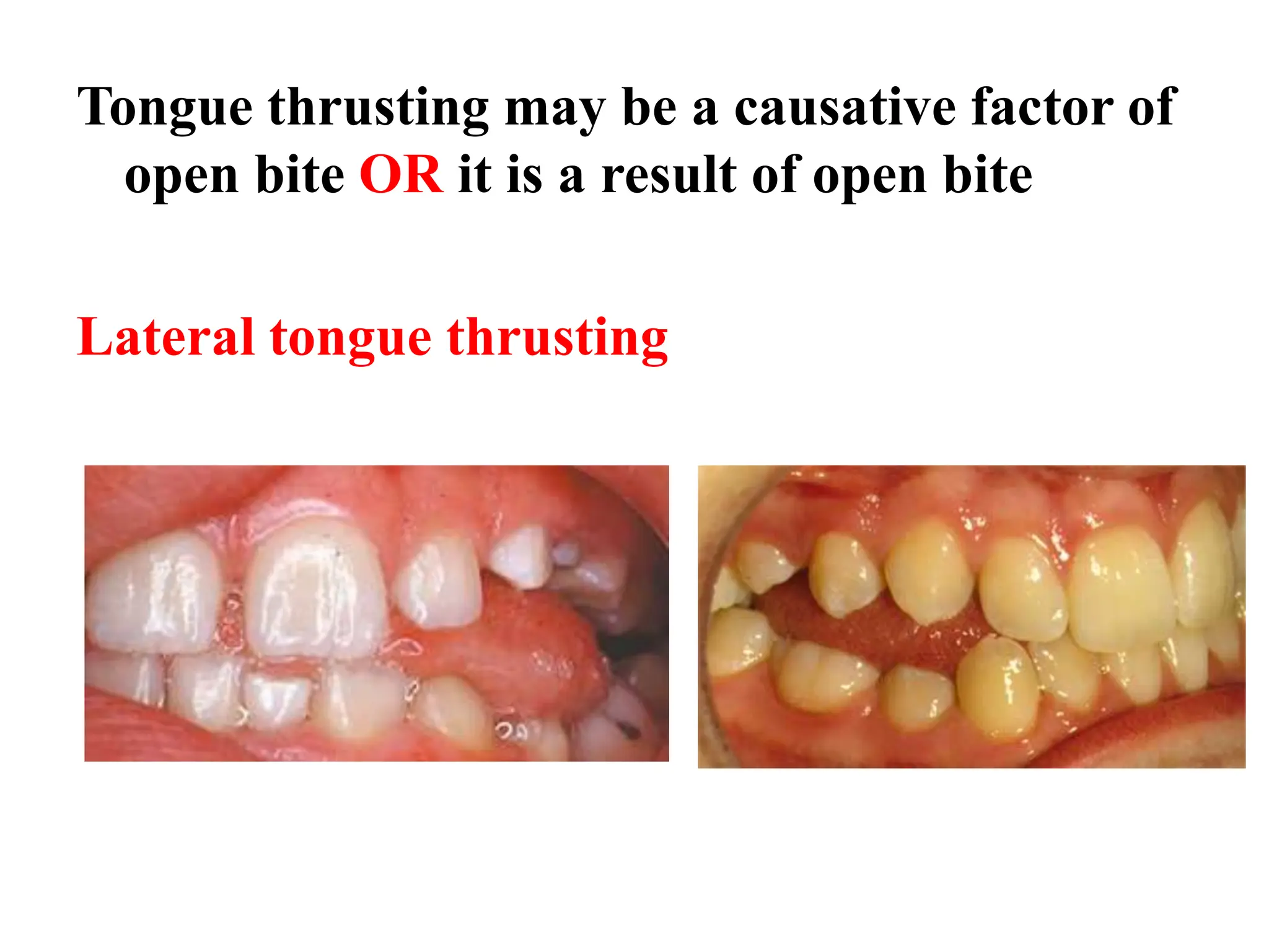 Management of open bite in orthodontics... | PPTX