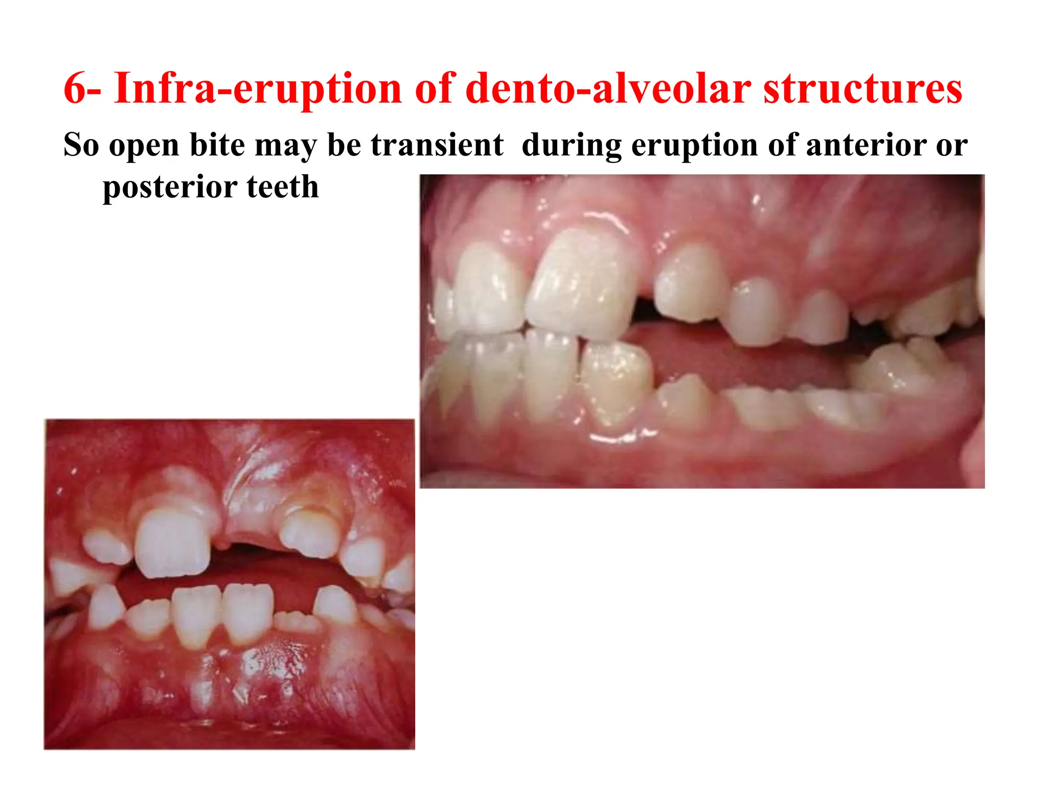 Management of open bite in orthodontics... | PPTX