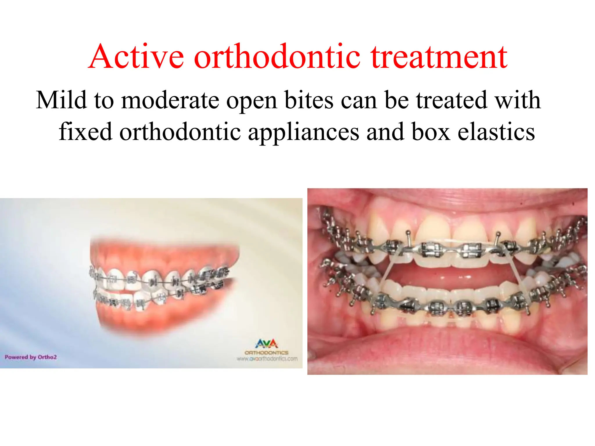 Management of open bite in orthodontics... | PPTX