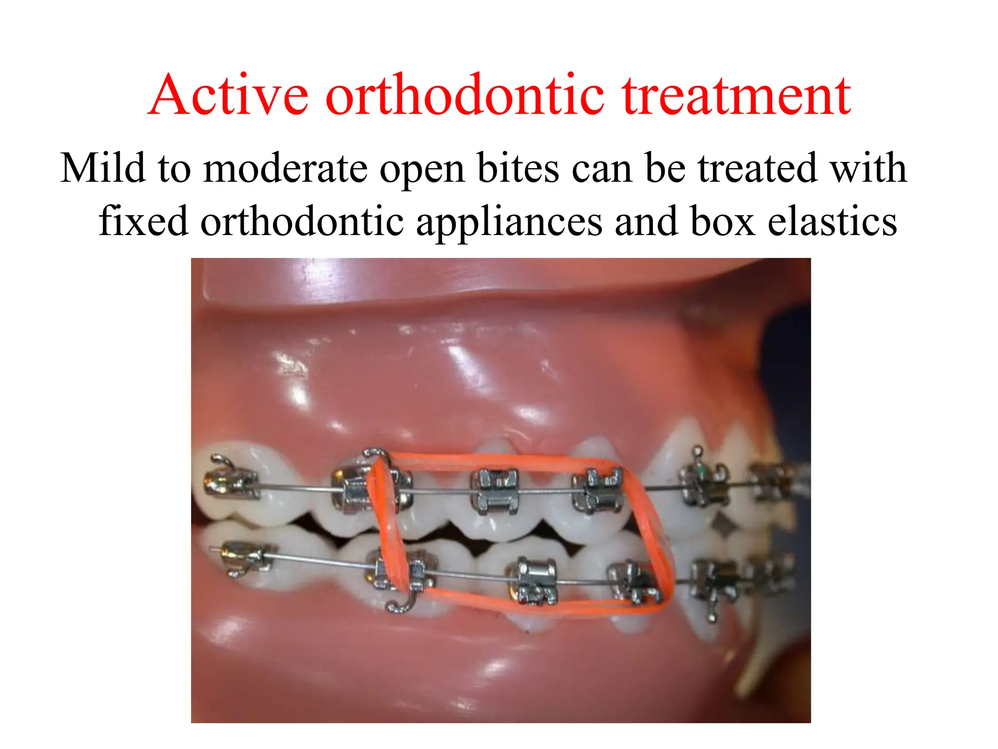 Management of open bite in orthodontics... | PPTX