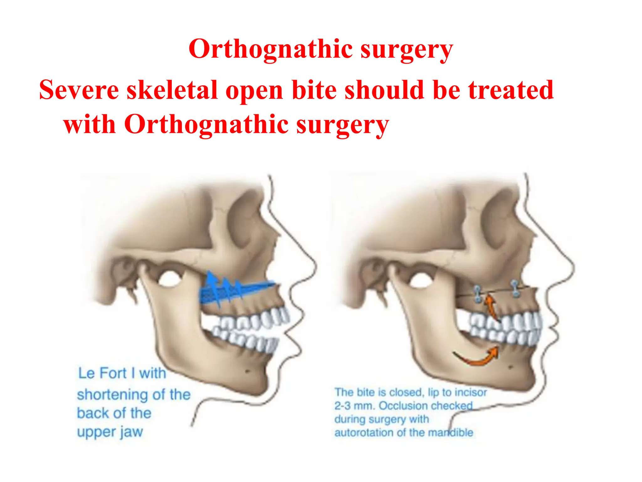 Management of open bite in orthodontics... | PPTX