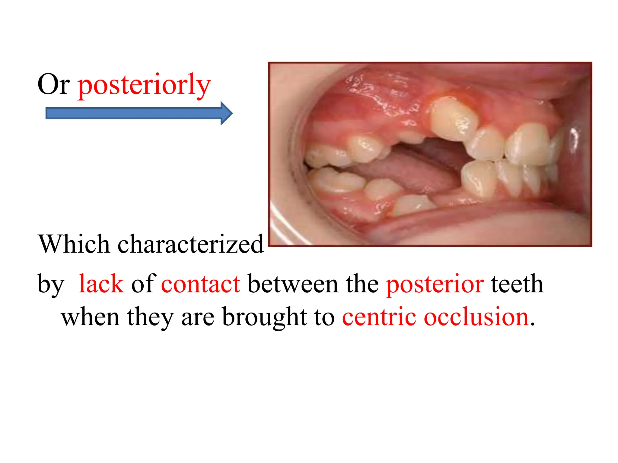 Management of open bite in orthodontics... | PPTX