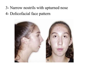 Management of open bite in orthodontics... | PPTX